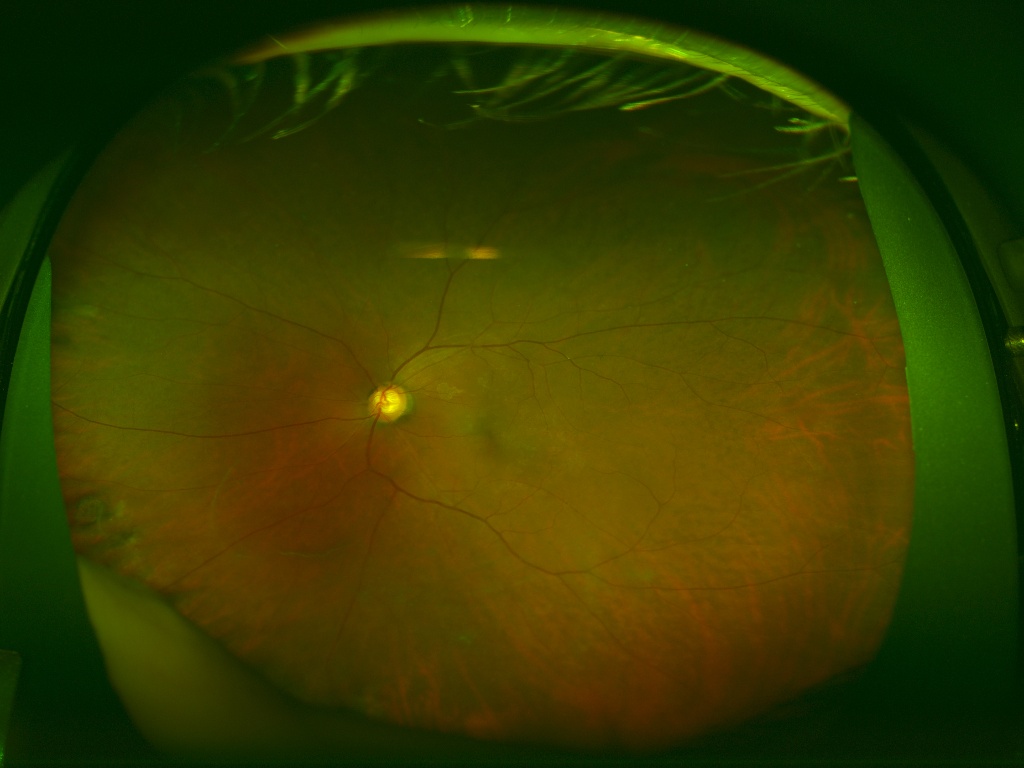 Image classification with wide-angle fundus image dataset